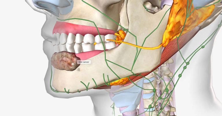 Oral Cancer - Rohilkhand Cancer Institute | Pet CT Scan in Bareilly